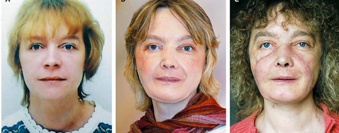Isabelle Dinoire Plastic Surgery Before and After Picture